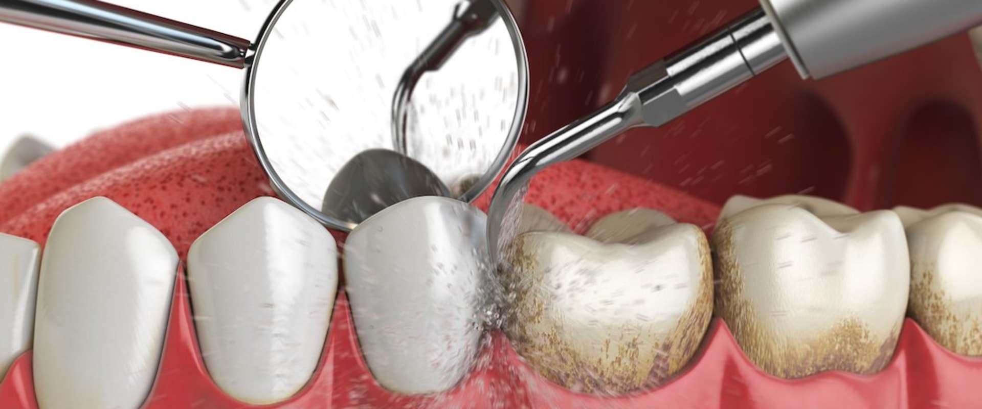 What Tools Do Dental Hygienists Use to Keep Your Teeth Healthy?